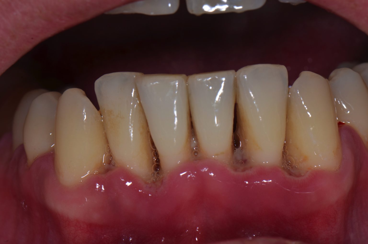 Les maladies parodontales - Cabinet dentaire à Toulon (les Halles) Dr ...